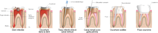 Endodontie - la dévitalisation ou Le traitement canalaire expliqué ...